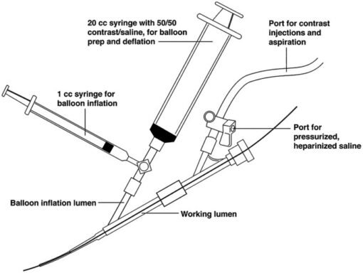 What To Do When A Foley Catheter Balloon Won’t Deflate